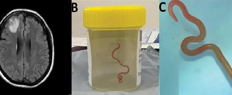 Live worm found in Australian woman's brain in world first ...