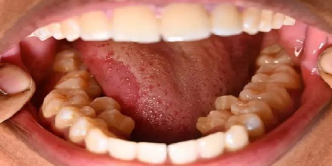 Indian woman with 38 teeth sets Guinness World Record - Pressmediaofindia