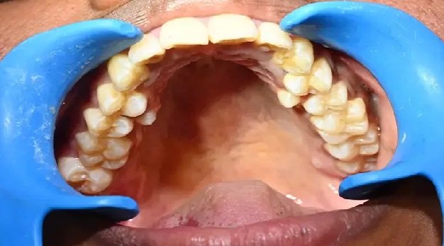 Indian woman with 38 teeth sets Guinness World Record - Pressmediaofindia